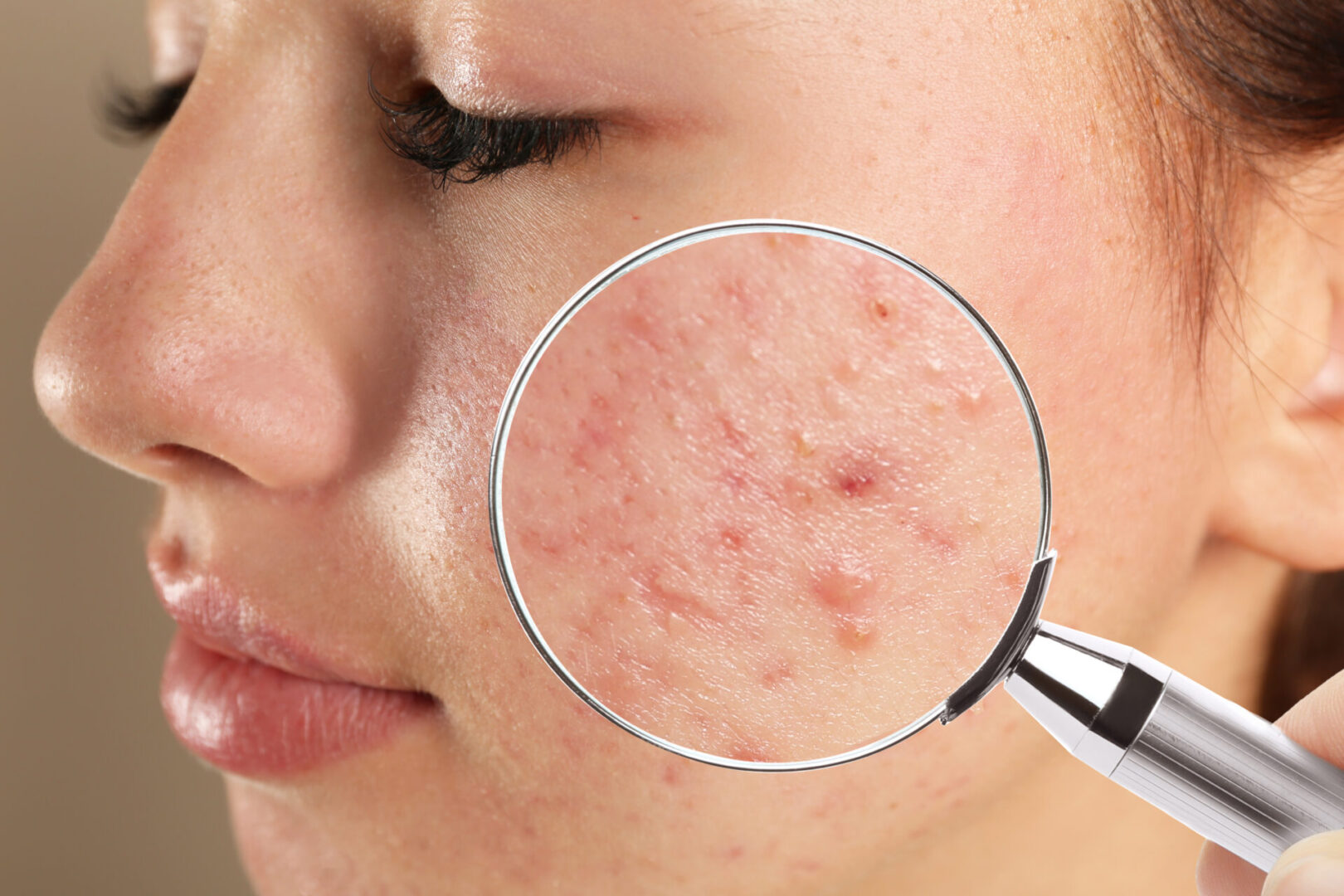 Battling Breakouts: The Best Facials for Acne-Prone Skin | Alux Spalon